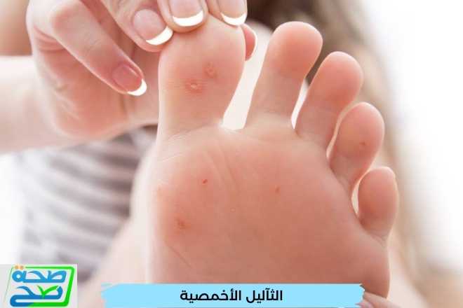 شكل الثالول بالصور و8 طرق لعلاجه