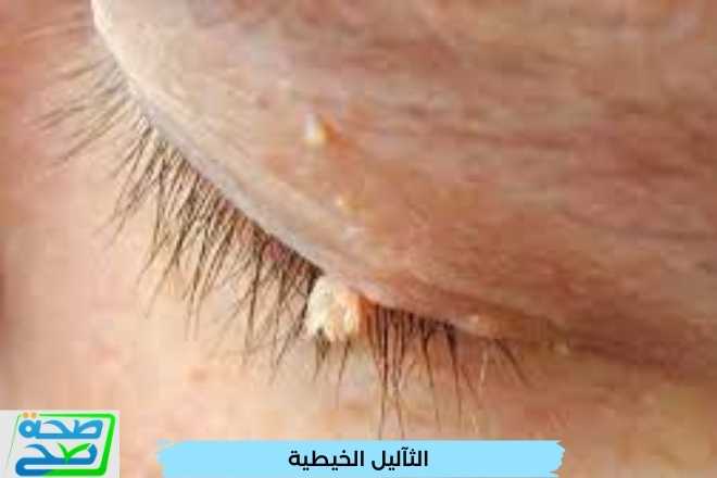 شكل الثالول بالصور و8 طرق لعلاجه