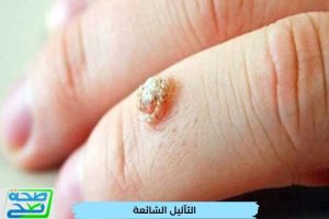 شكل الثالول بالصور و8 طرق لعلاجه