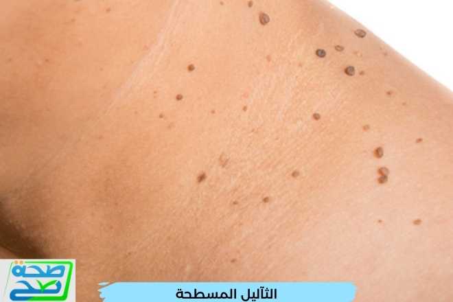 شكل الثالول بالصور و8 طرق لعلاجه